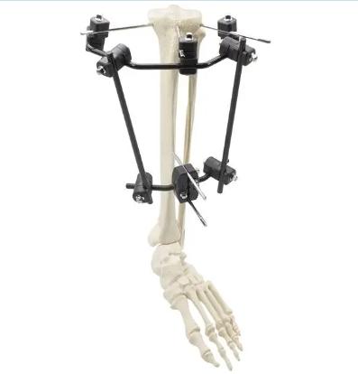 News - Innovative Treatment: The 8.0 Series External Fixator Brings ...