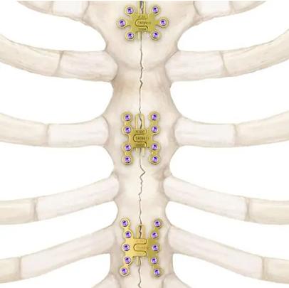 News - Innovative Medical Technology: Titanium Chest Locking Plate ...