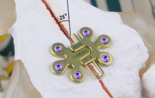 News - Innovative Medical Technology: Titanium Chest Locking Plate ...
