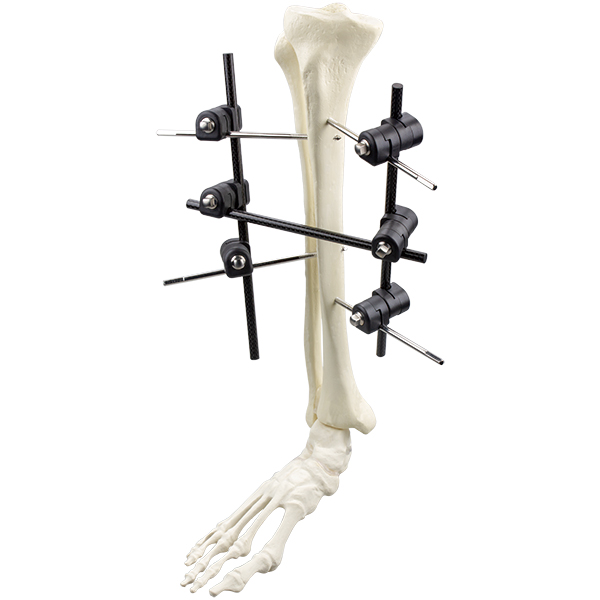 China Φ8.0 Series External Fixation Fixator – Tibia frame factory and ...