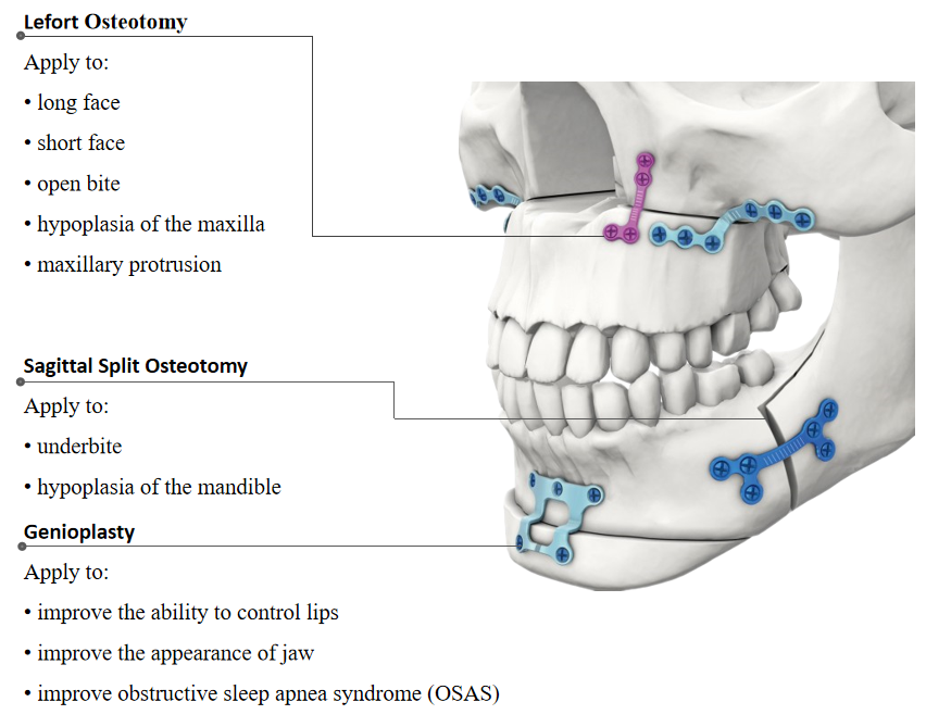 Sagittal split fixed plate-| iNature - Manufacturer & Sale